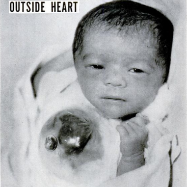 Baby born with heart outside body, named Corazon (“heart”) – Nancy’s ...